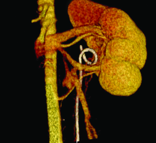 The All-Important Kidneys: Your Body’s Filter