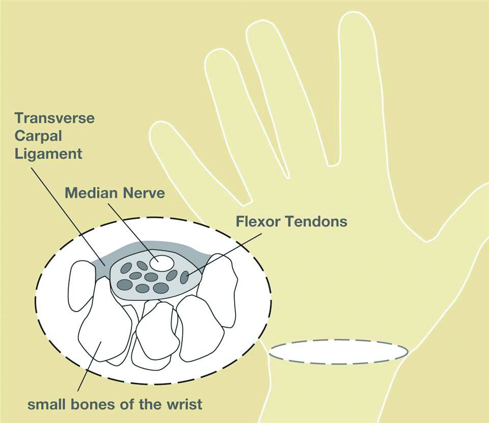 Relief from Carpal Tunnel Syndrome